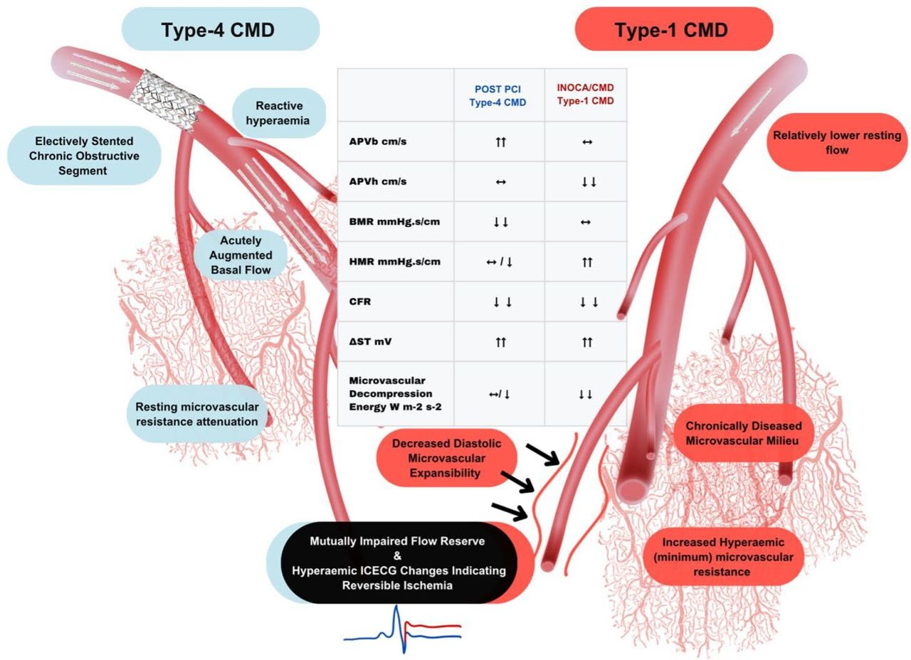 Primary versus iatrogenic (post-PCI) coronary microvascular dysfunction ...