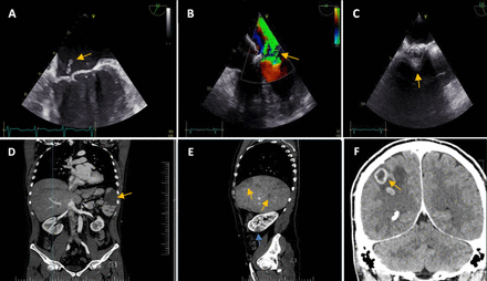 Embolic risk management in infective endocarditis: predicting the ...