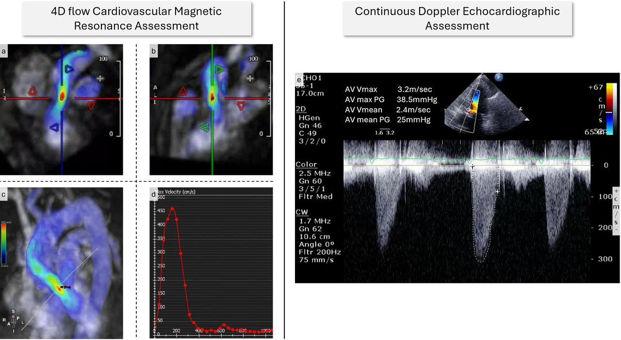 Four-dimensional flow provides incremental diagnostic value over ...