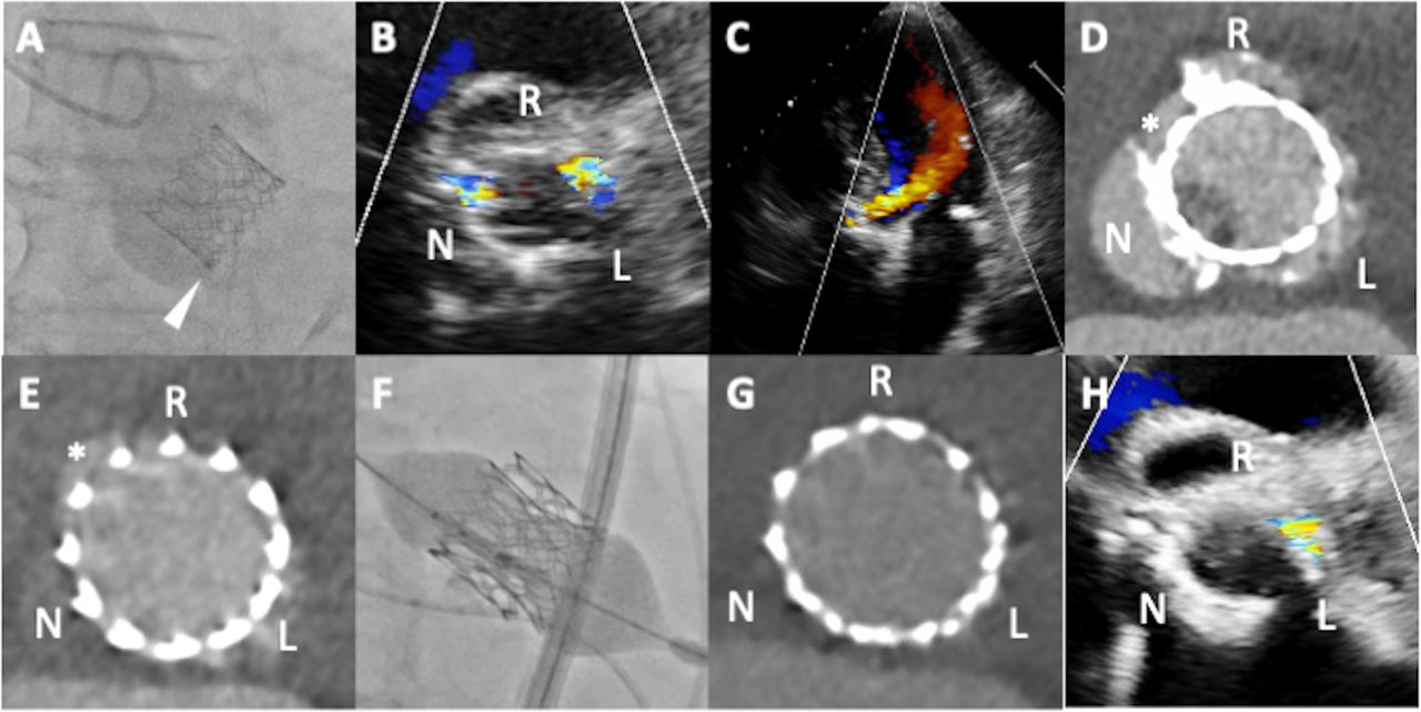 Clinically relevant haemolysis after transcatheter aortic valve ...