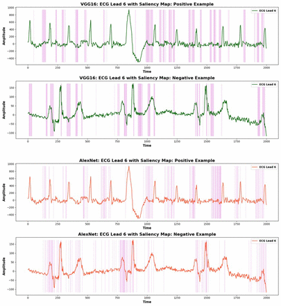 Integrating deep learning with ECG, heart rate variability and ...