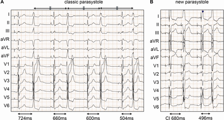 Prevalence of ventricular parasystole in patients with cardiac ...