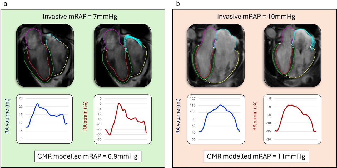 Cardiac MRI-derived mean right atrial pressure and its prognostic ...