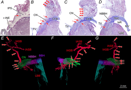 Anatomical characterisation of an additional atrioventricular node ...