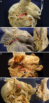 Anatomical characterisation of an additional atrioventricular node ...