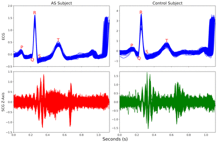 Severe aortic stenosis detection using seismocardiography | Open Heart