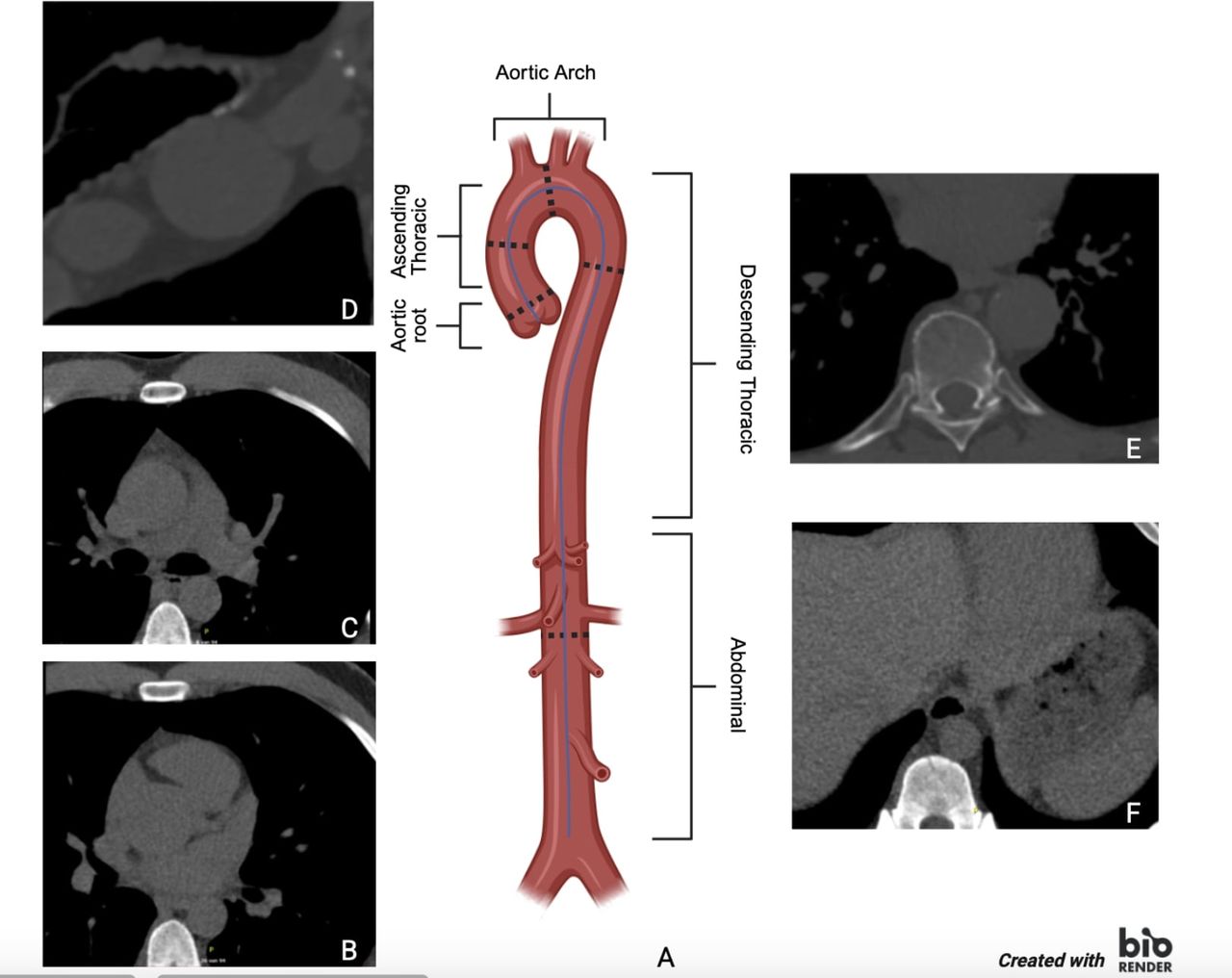 Ethnic variation in thoracic aortic dimensions in the general ...